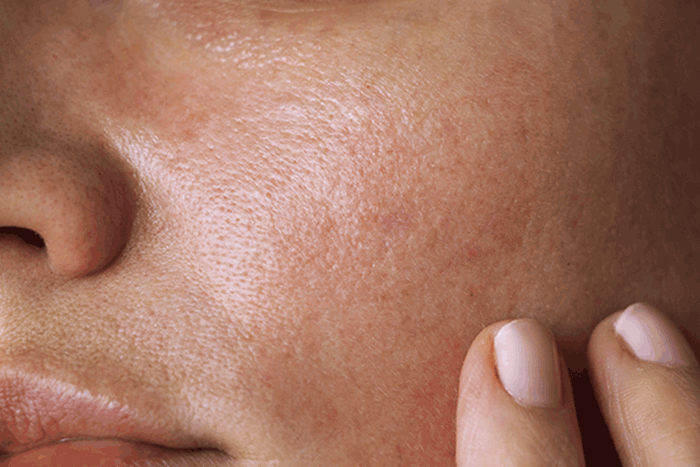 How to Care for Combination Skin using Metrin - Metrin Skincare